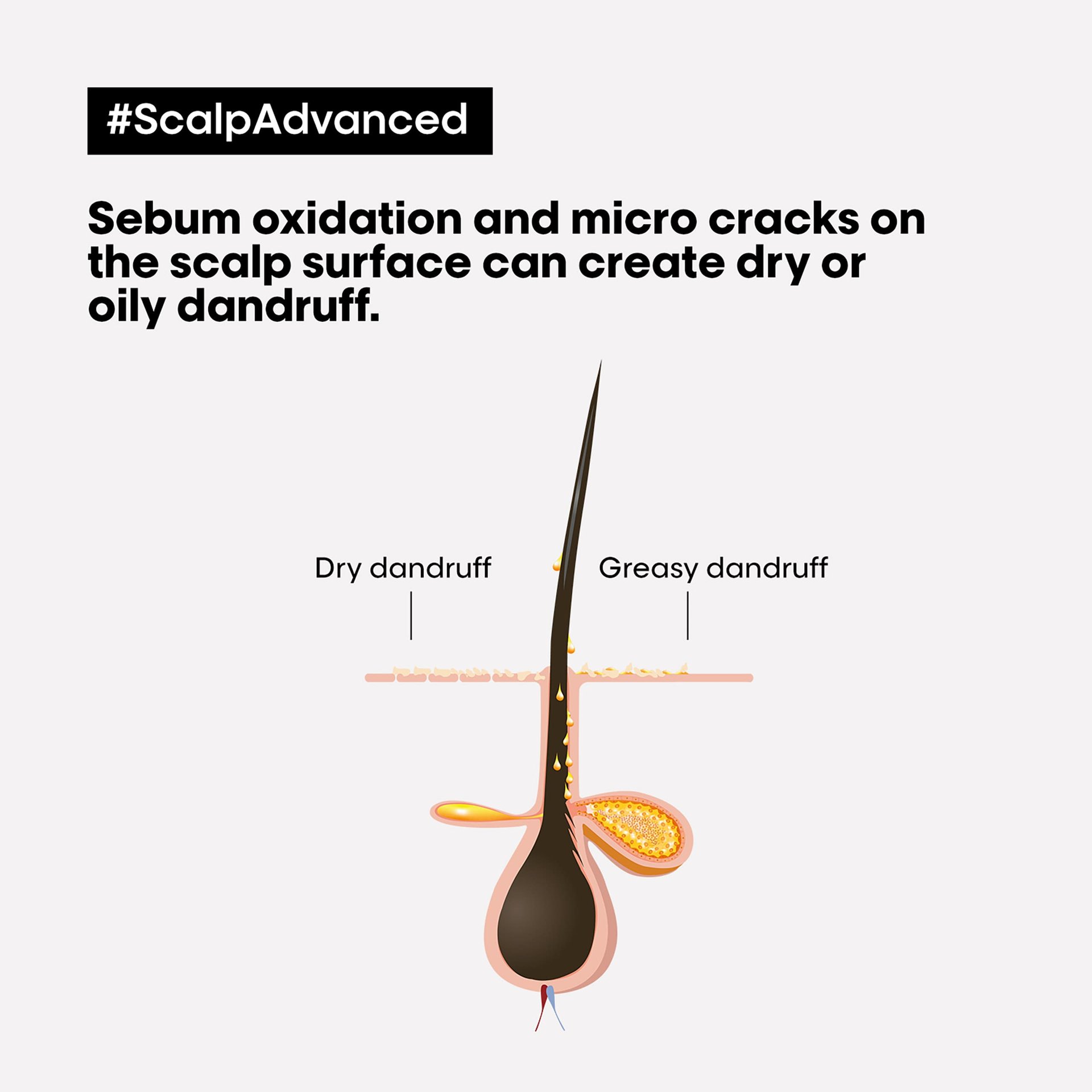 Scalp advanced anti-dandruff dermo-clarifier shampoo healthier scalps.