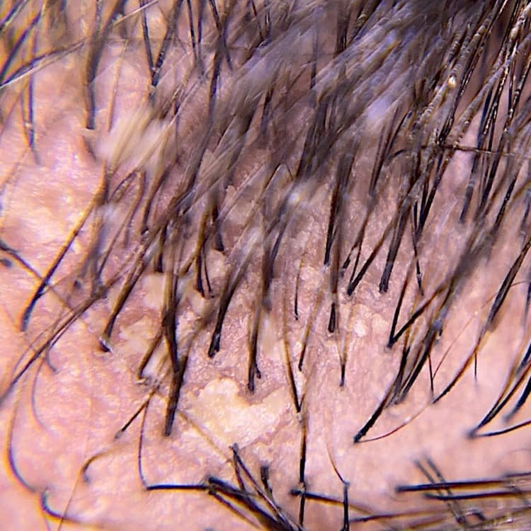 dandruff head under microscope