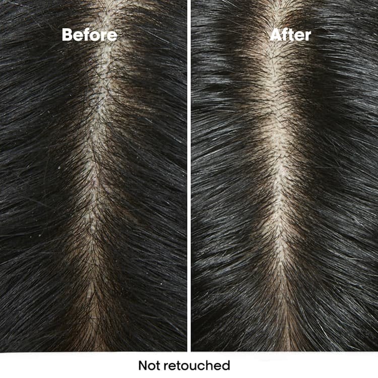 severe scalp dandruff